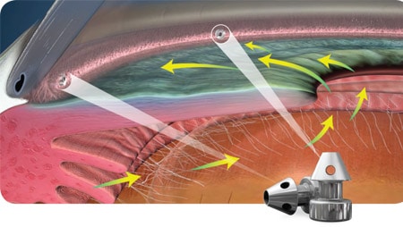 Performing the First iStent Inject Implants - Snead Eye Group